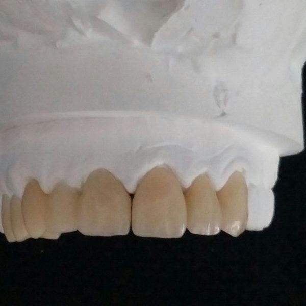 Prótesis Provisional ⋆ Laboratorio Dental Design